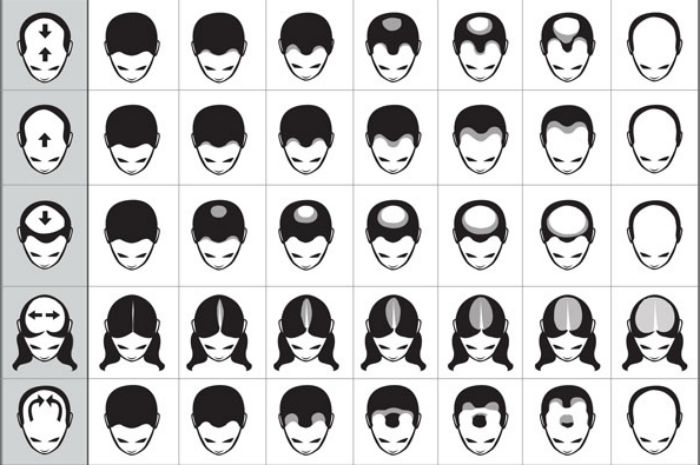 Typy vypadávání vlasů (alopecie) | eOtazky.cz