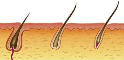 Vypadávání vlasů | eOtazky.cz